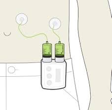 UC study: Subcutaneous infusion pump safe, effective for Parkinson’s ...