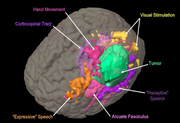Dual-Imaging Technique Useful Before-and During-Brain Surgery ...