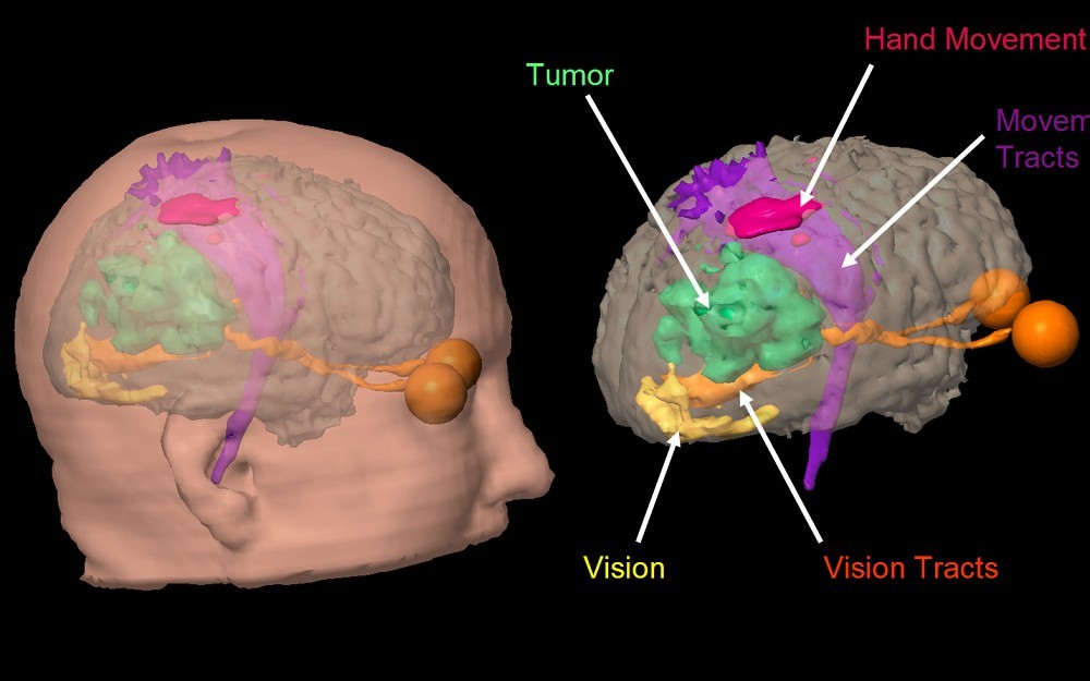 Dual-Imaging Technique Useful Before-and During-Brain Surgery ...